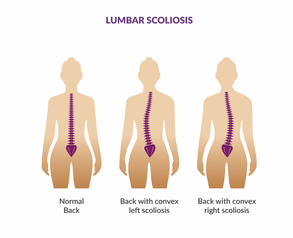 Lumbar Scoliosis Symptoms And Treatment Pathway Spine 3D Lumbar Scoliosis Symptoms And Treatment Pathway Spine 3D